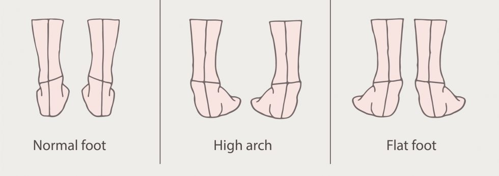 Do I Have Flat Feet?